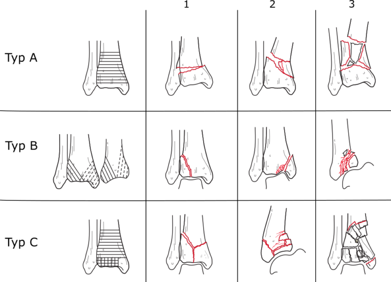 Tibiafraktur, Distal | Ortobas