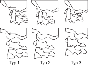 Atlanto-Occipital Dislokation – Ortobas