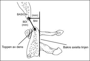 Atlanto-Occipital Dislokation – Ortobas