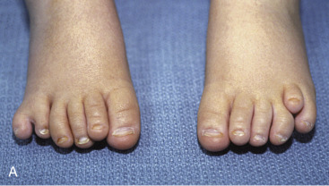 Polydaktyli, Tår (Barn) | Ortobas