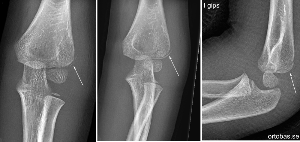 Humeruskondylfraktur, Radial (Barn) | Ortobas
