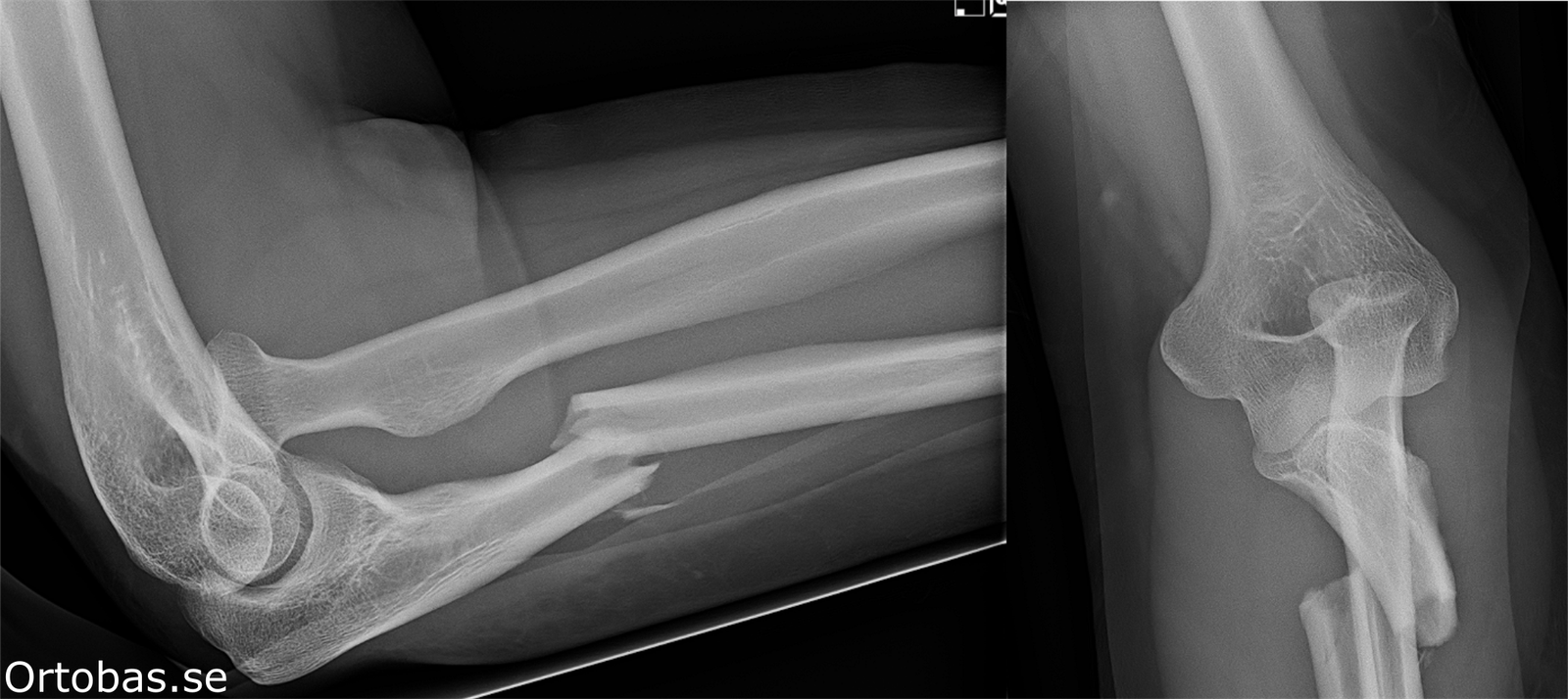 Monteggia-fraktur | Ortobas
