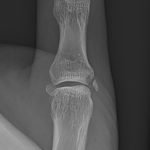 RCL-skada, MCP-1, Akut | Ortobas