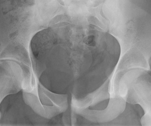 Ewing-sarkom | Ortobas