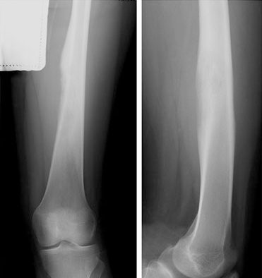 Ewing-sarkom | Ortobas