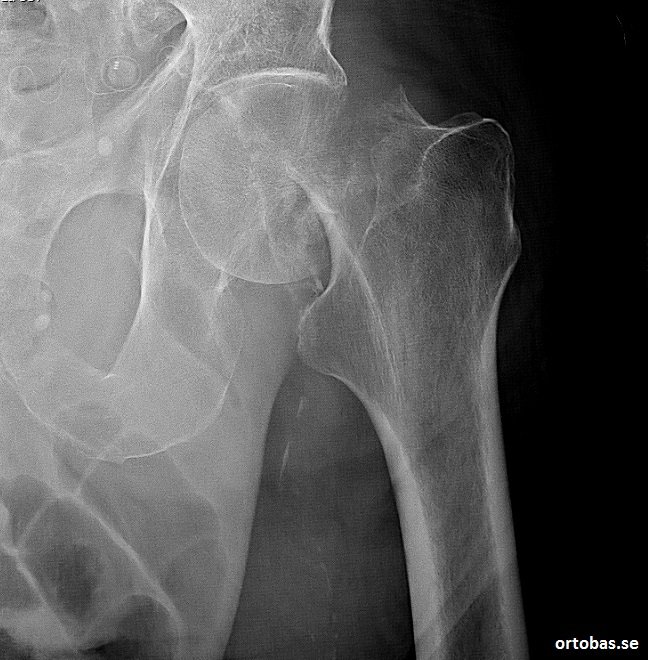 Femurfraktur, Cervikal | Ortobas