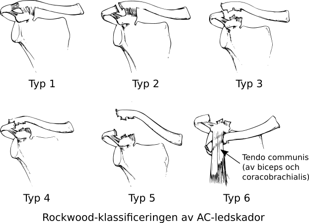 Acromioclavicularledsskada – Ortobas