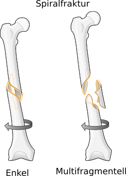 Frakturlära | Ortobas